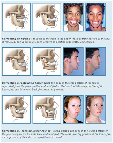 Distal Jet Appliance - Orthodontics Appliances - Garden City ...