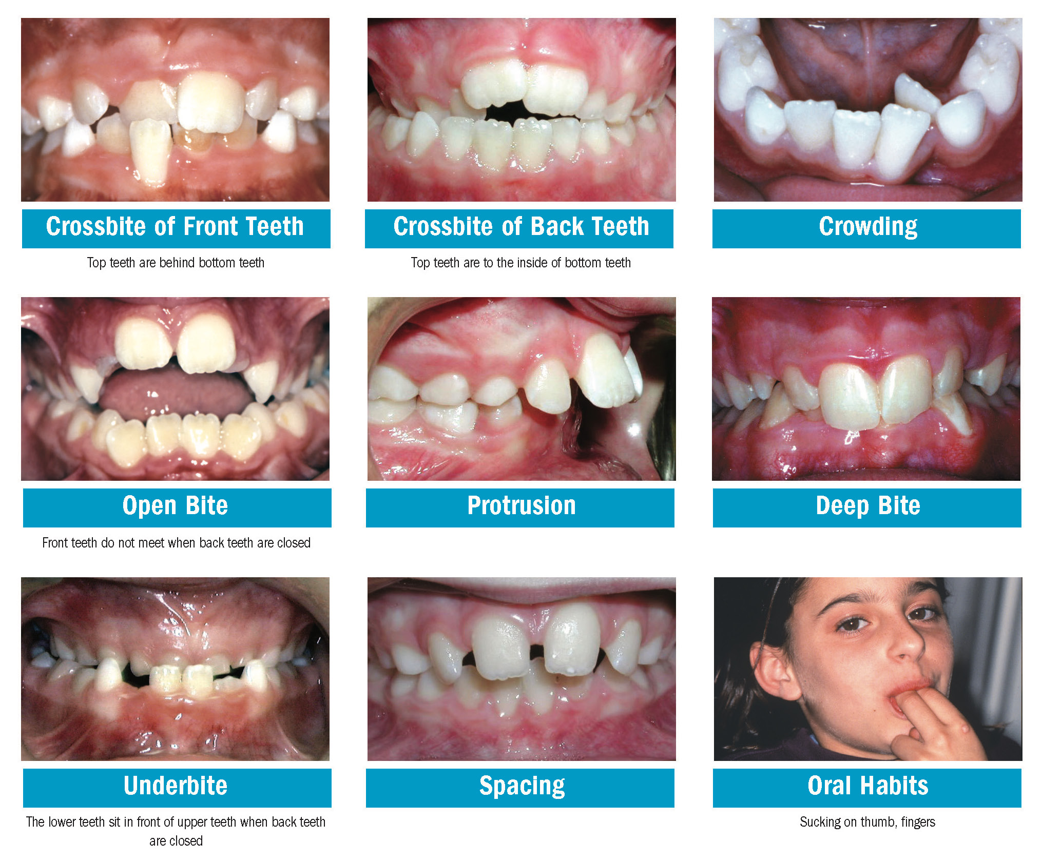 Orthodontics for Children - Doctor Emma