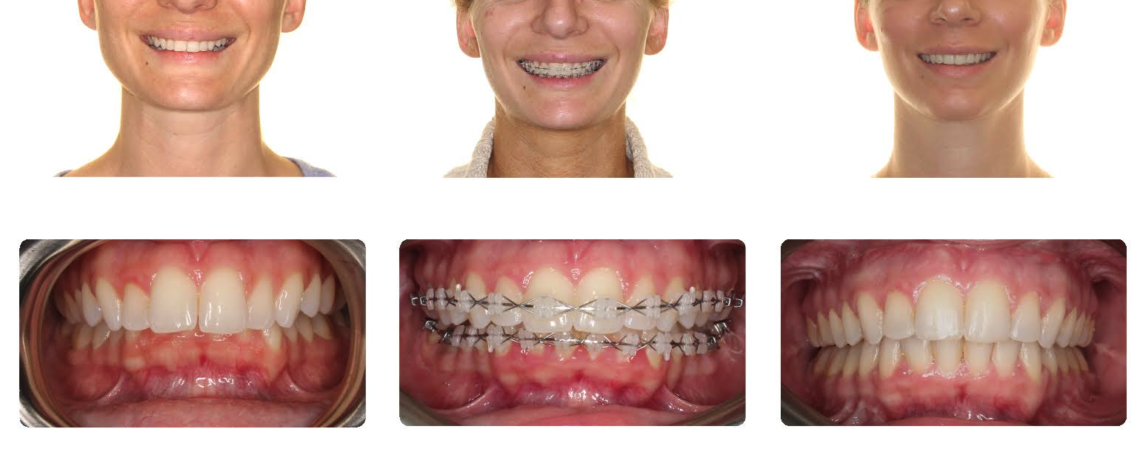 Orthognathic Jaw Surgery Before and After - Doctor Emma