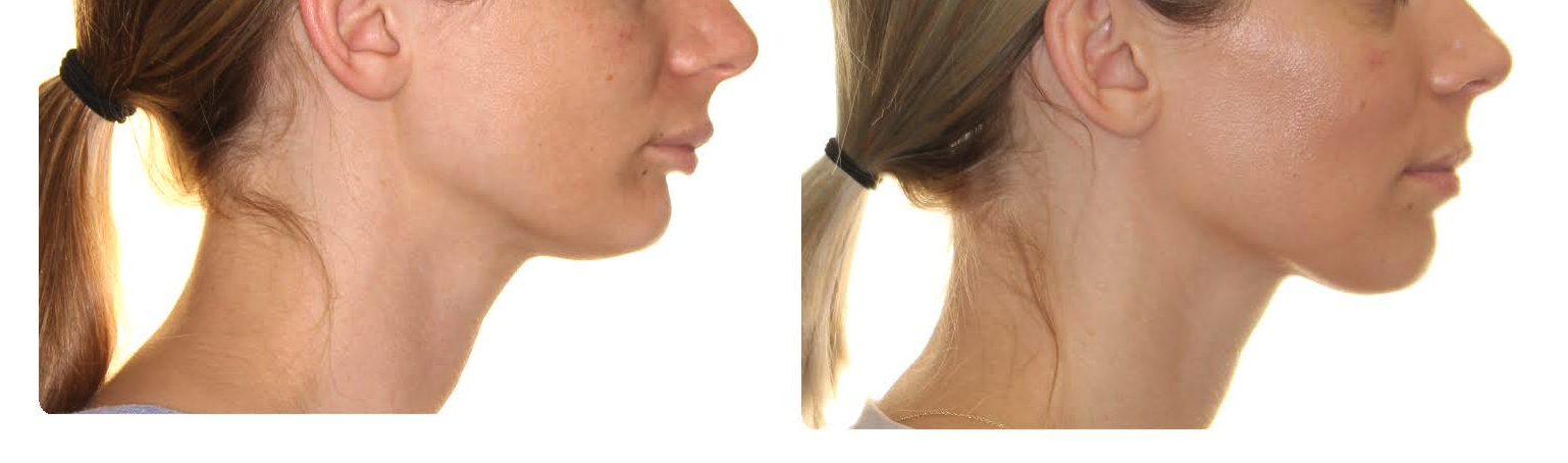 Orthognathic Jaw Surgery Before and After - Doctor Emma