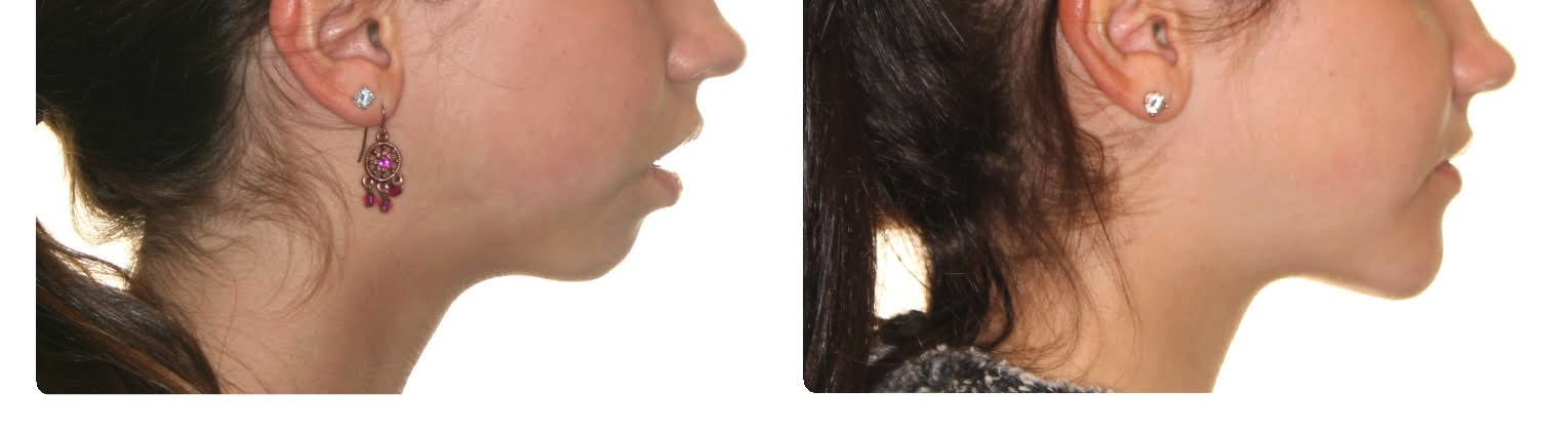Orthognathic Jaw Surgery Before and After - Doctor Emma
