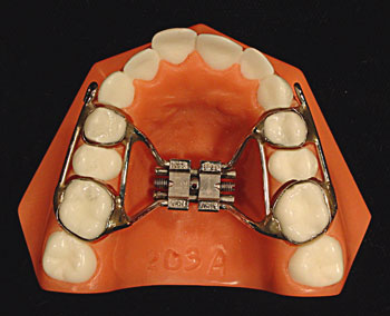 Palatal Expander - Orthodontic Appliances - Doctor Emma