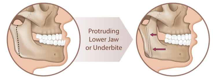 Orthognathic Jaw Surgery - Doctor Emma
